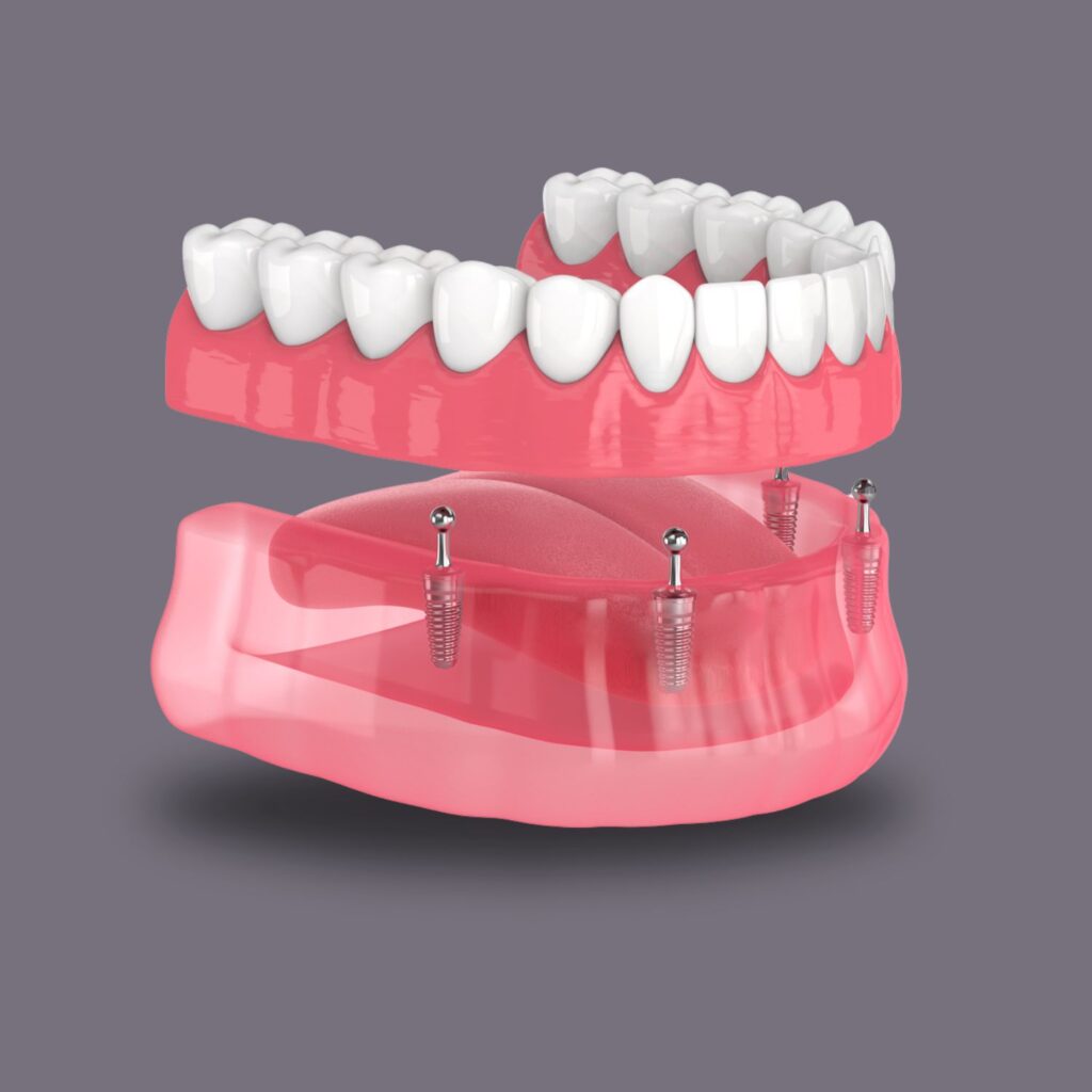 Dentures in Creve Coeur, MO | Comfortable Tooth Replacement Options